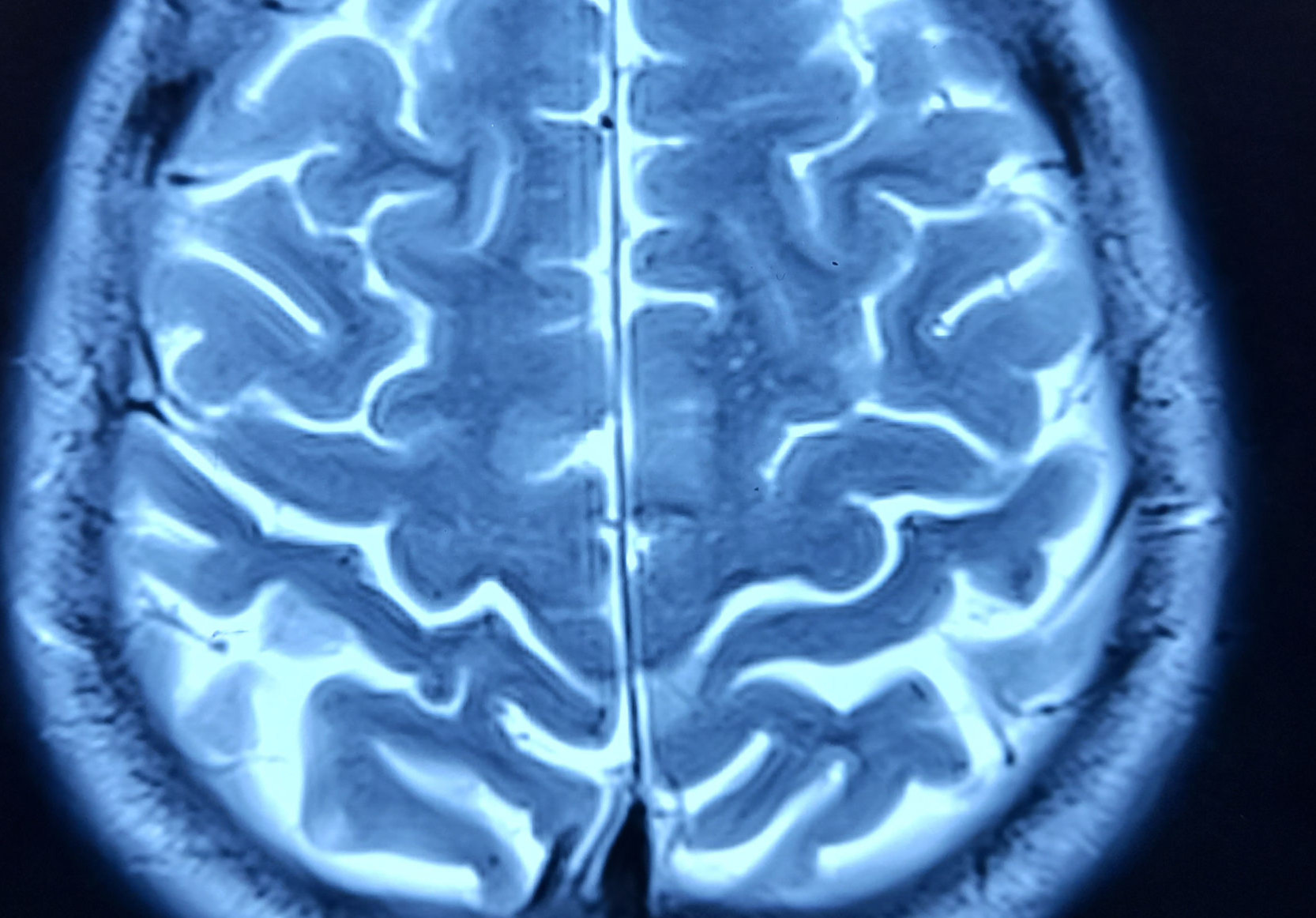 Brain Scanning Approach Shows Wiring of Depression - - MedEd On The Go